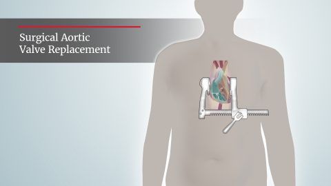 Surgical aortic valve replacement through open heart surgery