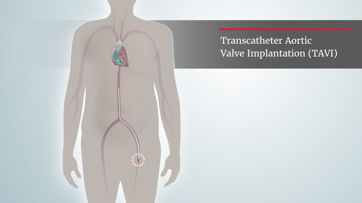 What is a Transcatheter Aortic Valve Replacement (TAVR) Procedure?